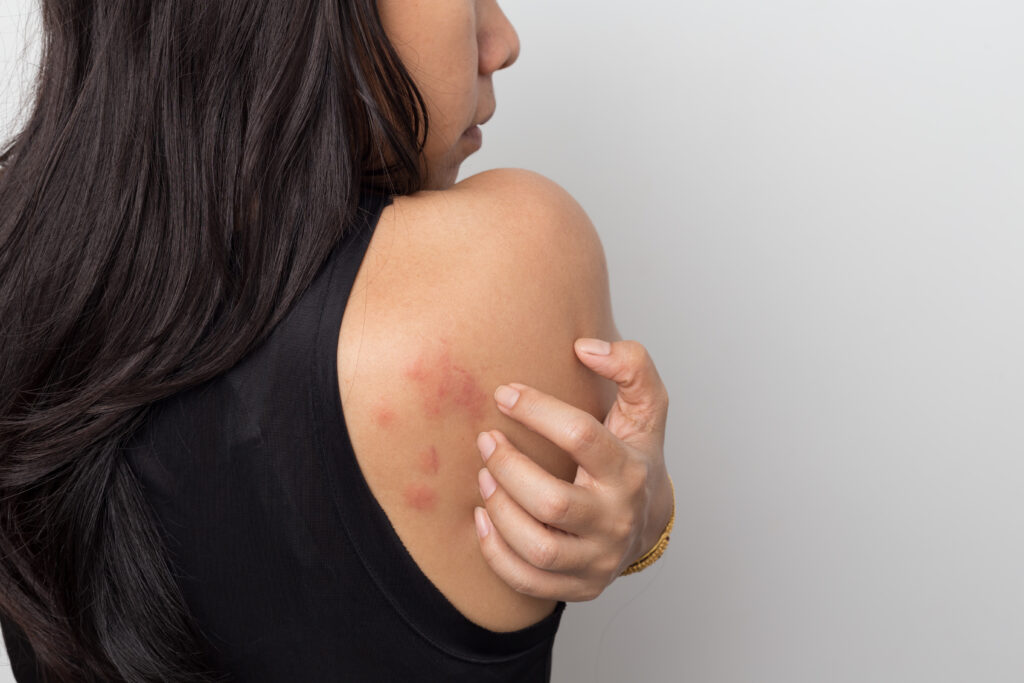 Urticaria (Hives): Symptoms, Causes, and Treatment